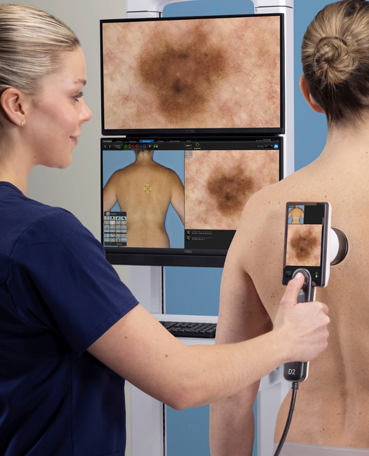 Mole Mapping in Ottawa – Factor Dermatology